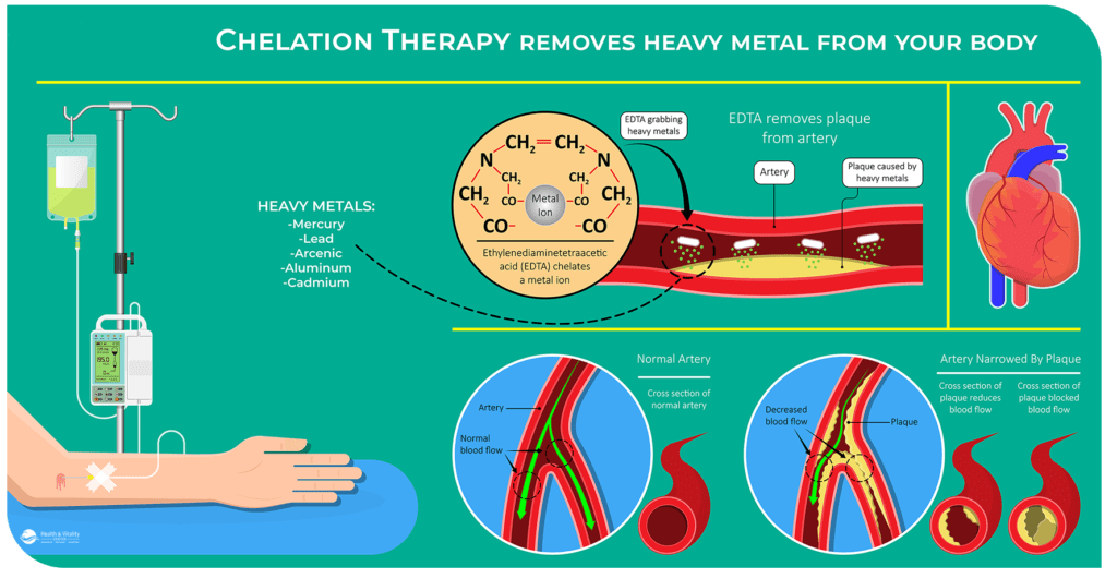 G7-101010: How does IV chelation therapy work?