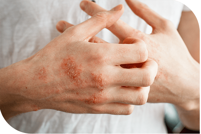 Contact Dermatitis Natural Treatment - Manage Contact Dermatitis