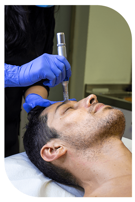 PRP Microneedling | Best Vampire Facial in Los Angeles